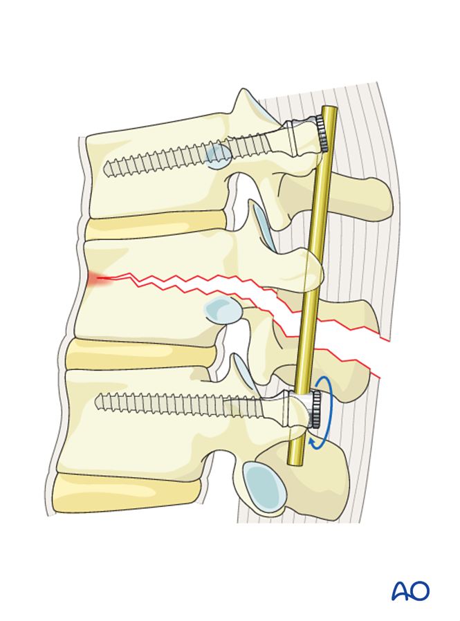 Posterior short segment fixation with pedicle screws for B1 ...