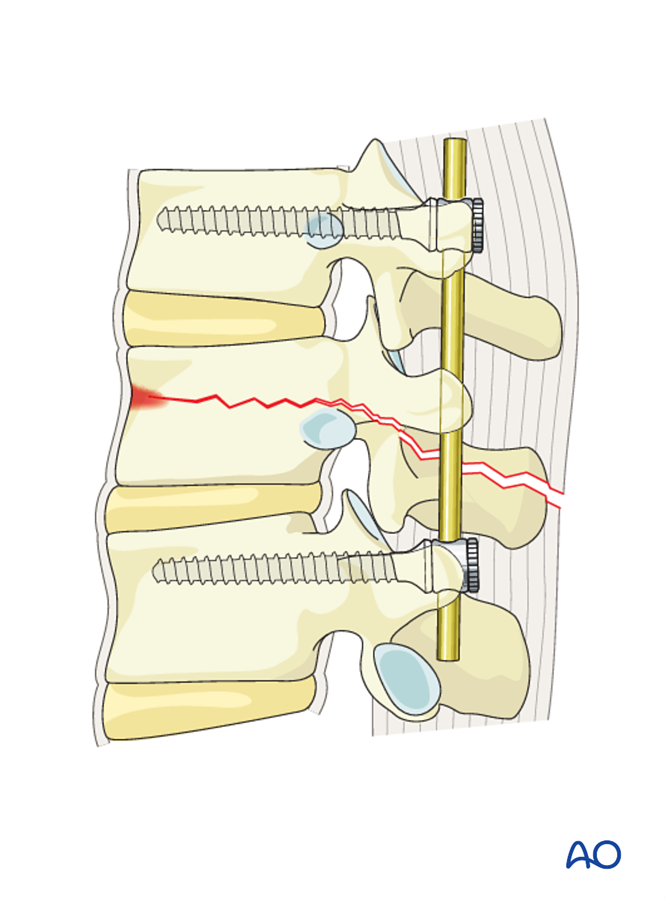 Posterior short segment fixation with pedicle screws for B1 ...
