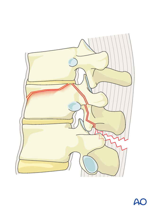 MIS posterior short segment fixation with pedicle screws for B2 ...