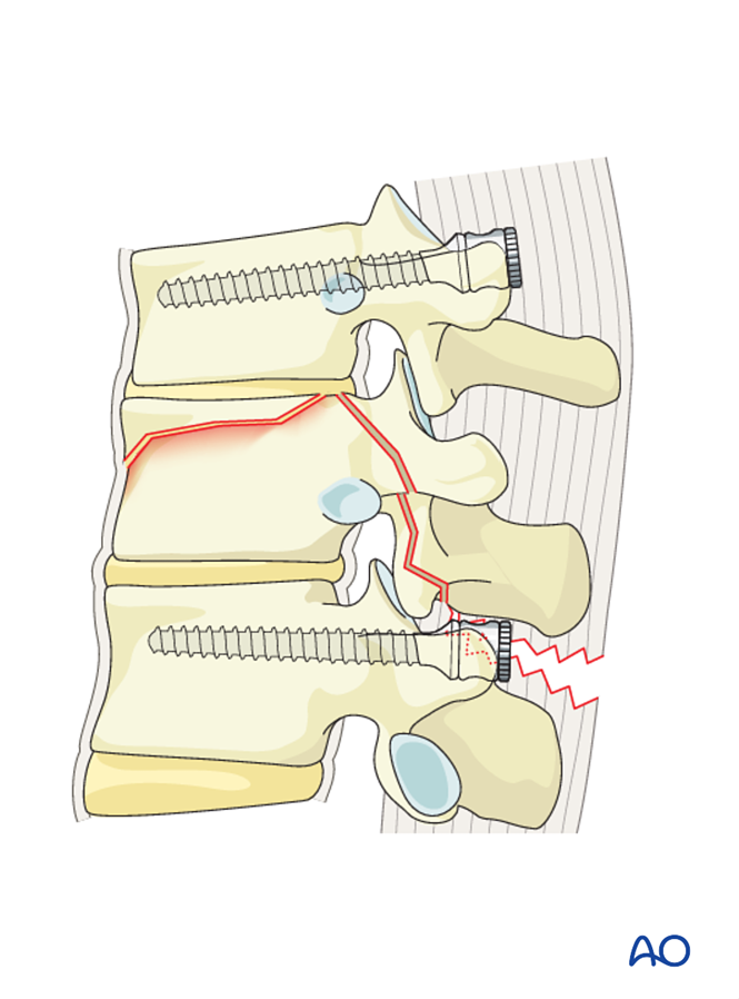 MIS posterior short segment fixation with pedicle screws for B2 ...