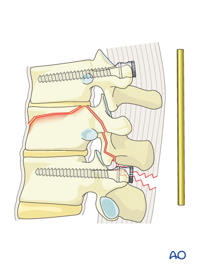 MIS posterior short segment fixation with pedicle screws for B2 ...
