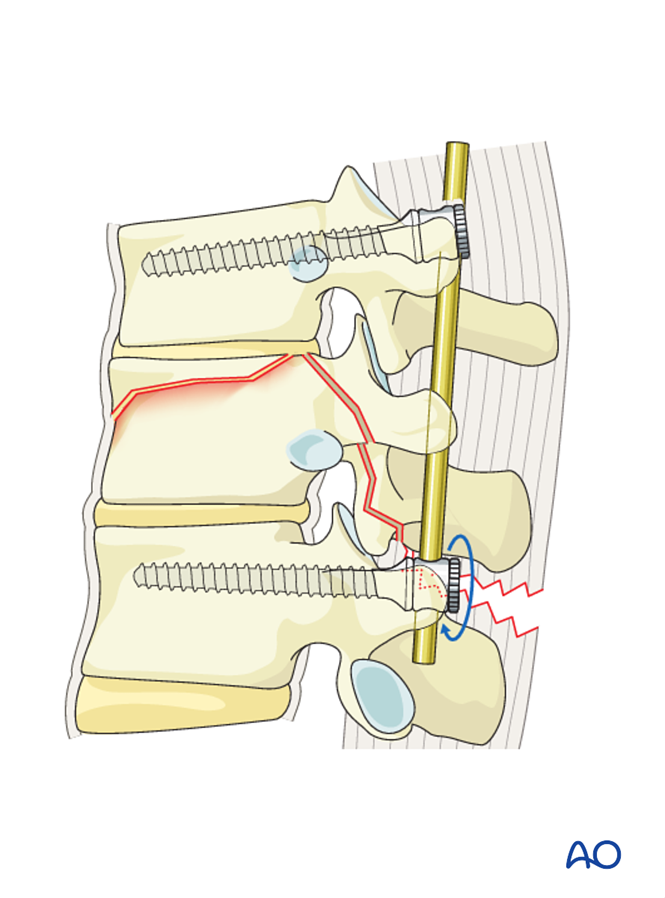 MIS posterior short segment fixation with pedicle screws for B2 ...