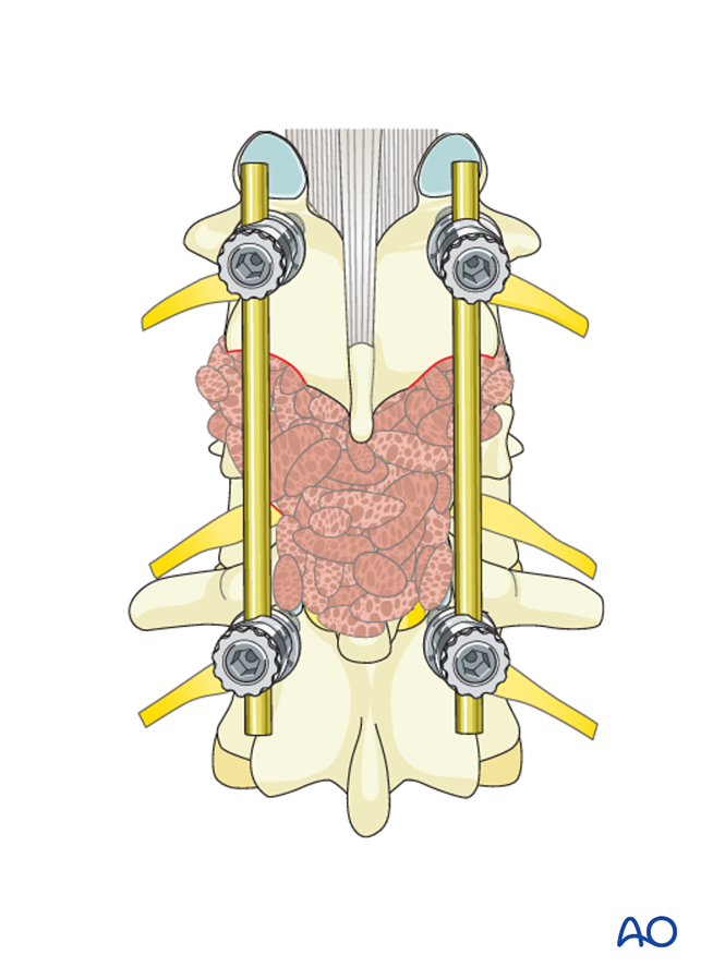 MIS posterior short segment fixation with pedicle screws for B2 ...