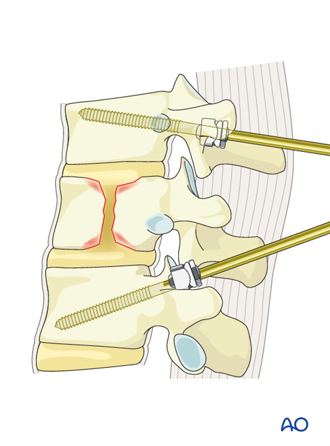 Posterior short segment fixation with Schanz pins for A2 - Split fractures