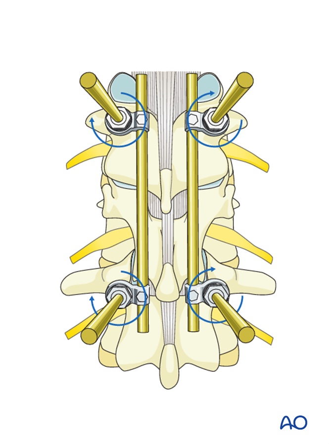 Posterior short segment fixation with Schanz pins for A2 - Split fractures
