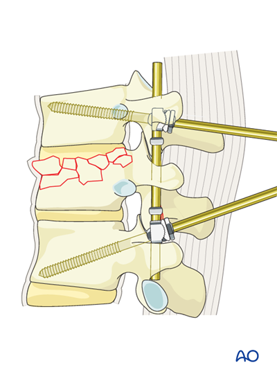MIS posterior short segment fixation with Schanz pins for A3 Incomplete ...