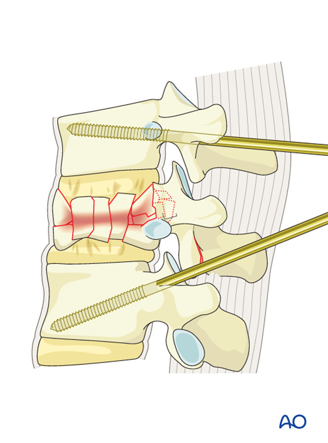 Posterior short segment fixation with Schanz pins for A4 Complete burst ...