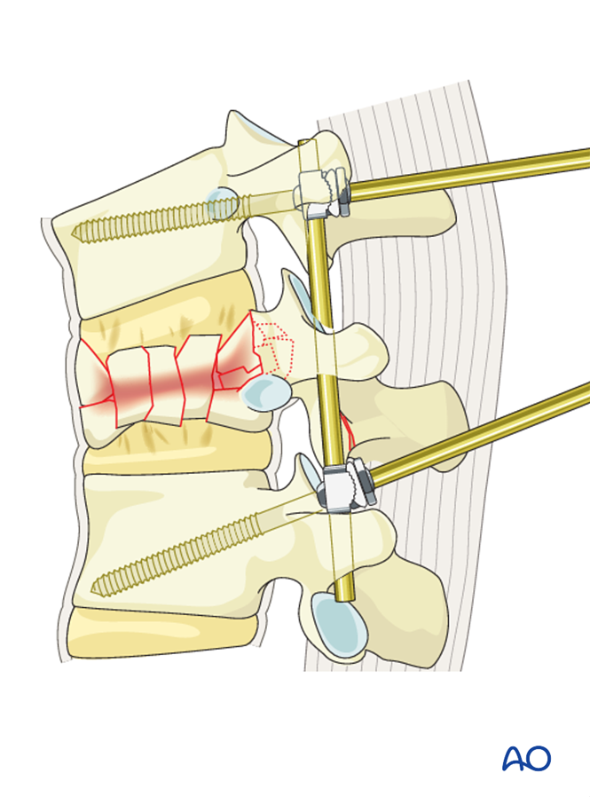Posterior short segment fixation with Schanz pins for A4 Complete burst ...