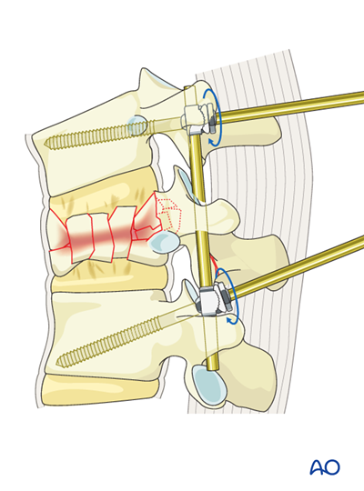 Posterior short segment fixation with Schanz pins for A4 Complete burst ...