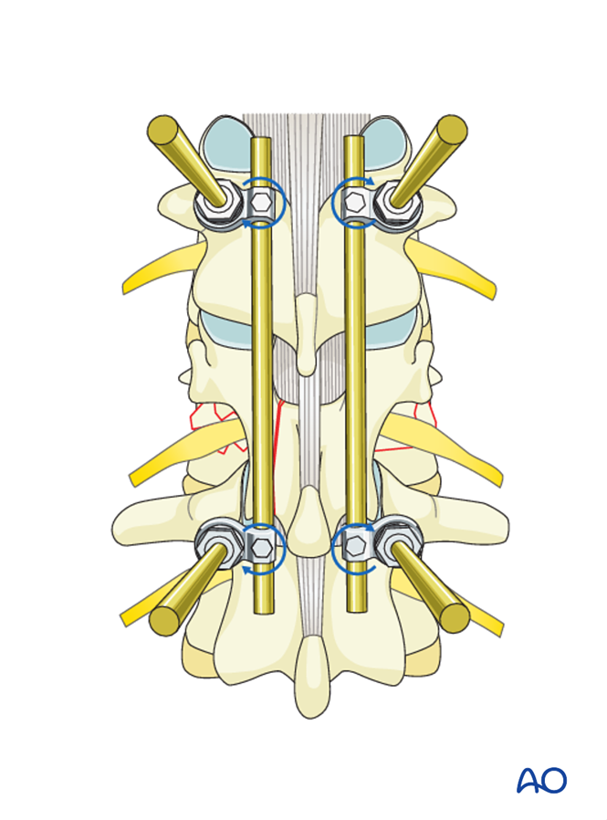 Posterior short segment fixation with Schanz pins for A4 Complete burst ...