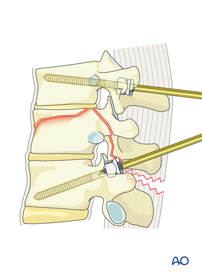 Posterior short segment fixation with Schanz pins for B2 Posterior ...