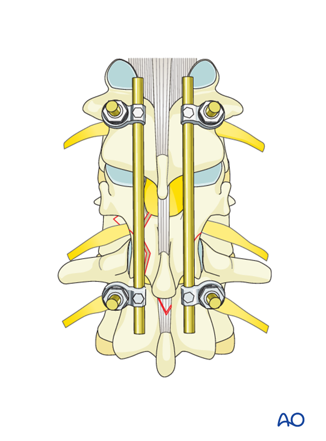 Posterior short segment fixation with Schanz pins for B2 Posterior ...