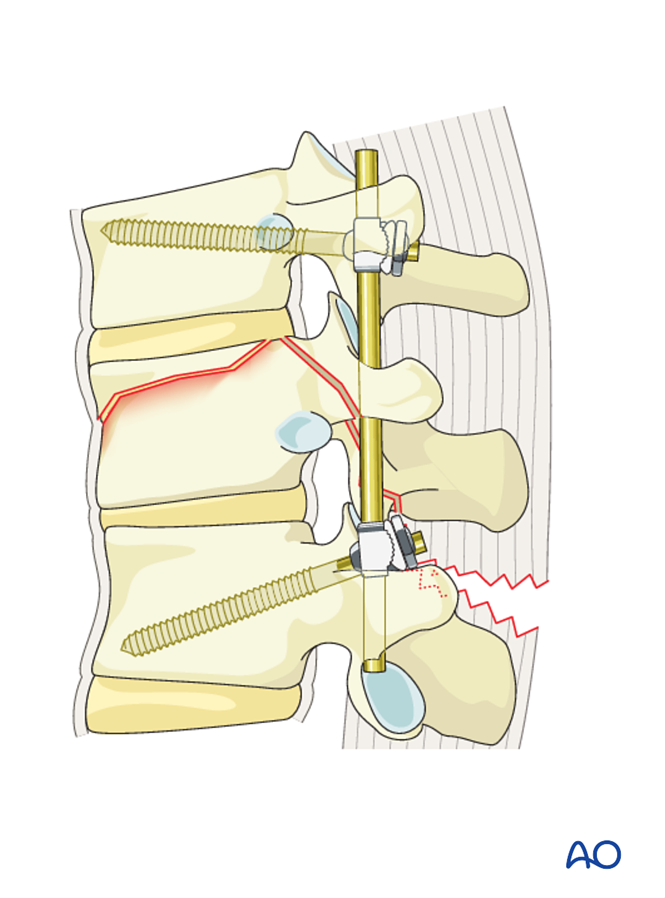 Posterior short segment fixation with Schanz pins for B2 Posterior ...