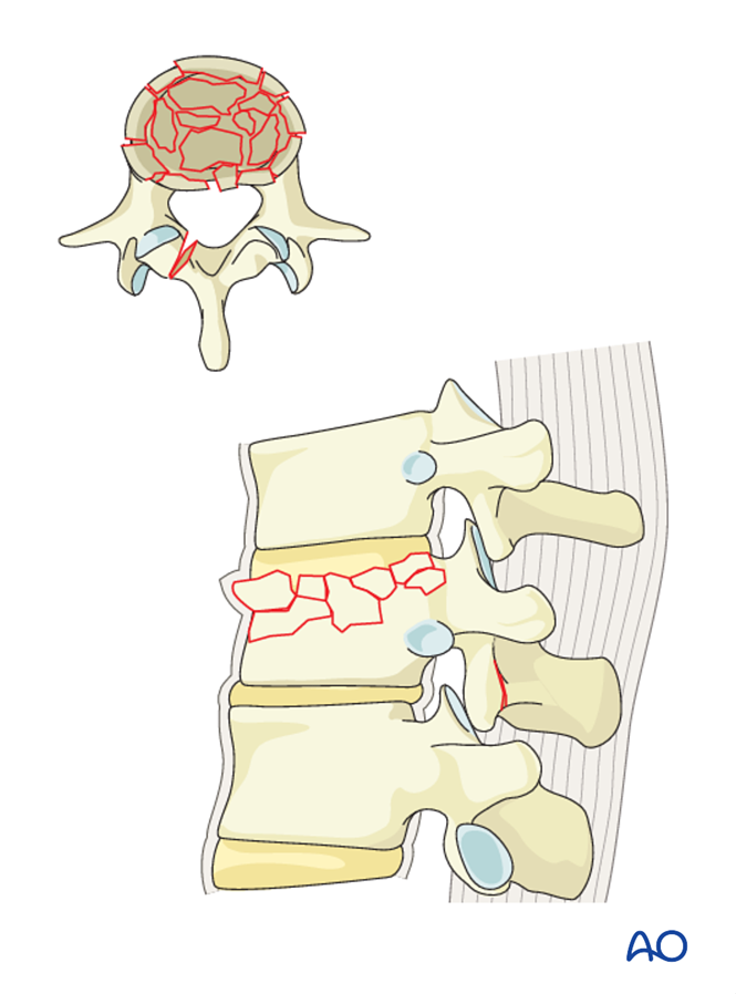 Posterior short segment fixation with intermediate screws for A3 ...