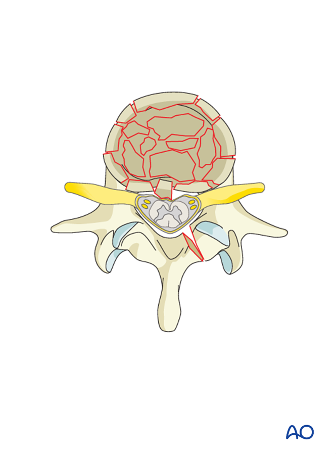Posterior short segment fixation with intermediate screws for A3 ...
