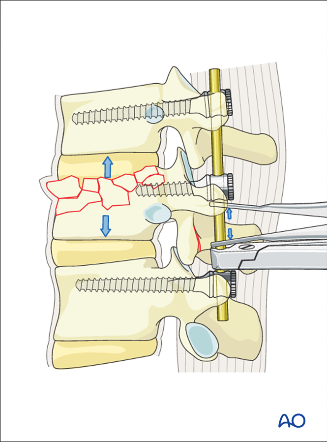 Posterior short segment fixation with intermediate screws for A3 ...