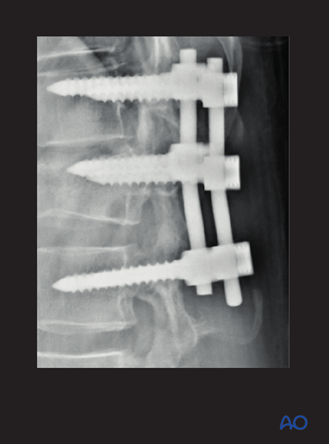 Posterior short segment fixation with intermediate screws for A4 ...