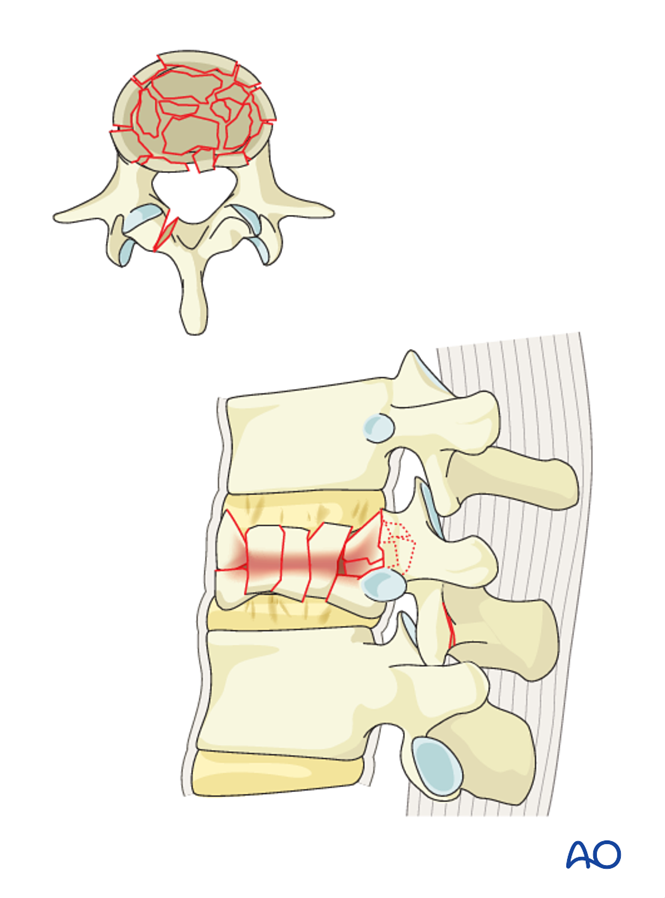 Posterior short segment fixation with intermediate screws for A4 ...