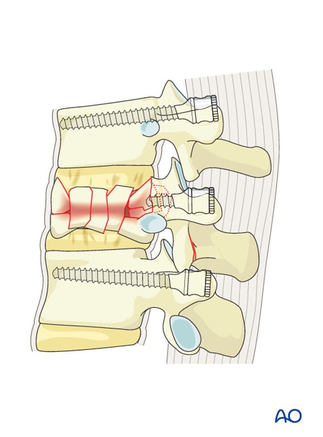 Posterior short segment fixation with intermediate screws for A4 ...