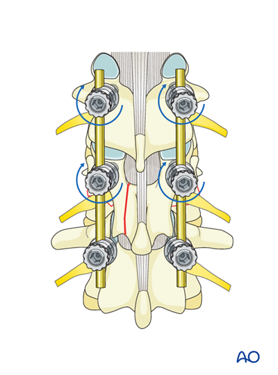 Posterior short segment fixation with intermediate screws for A4 ...