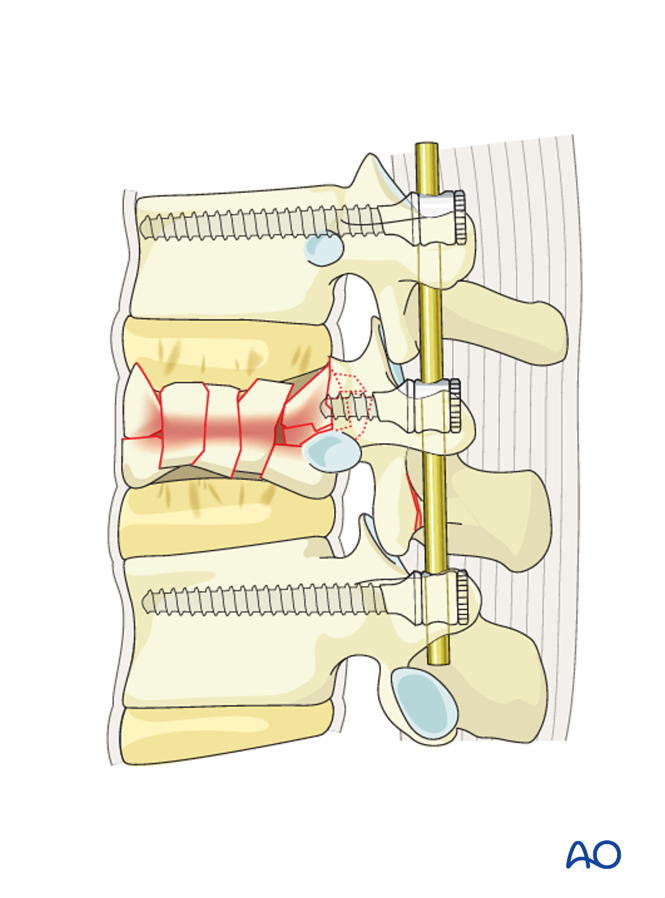 Posterior short segment fixation with intermediate screws for A4 ...
