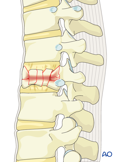 Posterior long segment fixation for A4 Complete burst fractures