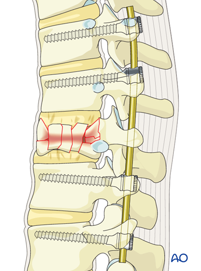 Posterior long segment fixation for A4 Complete burst fractures