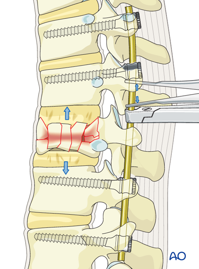 Posterior long segment fixation for A4 Complete burst fractures