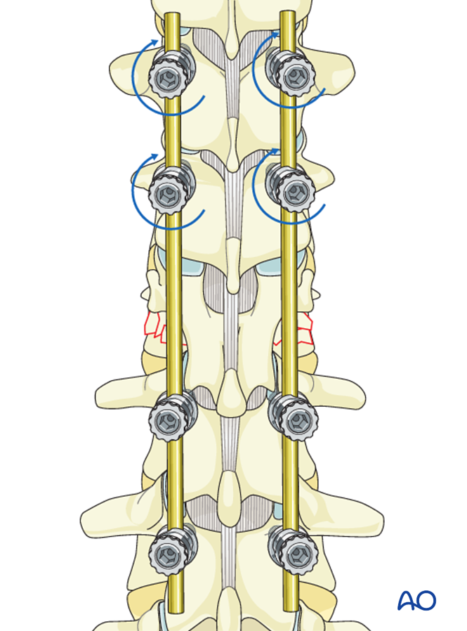Posterior long segment fixation for A4 Complete burst fractures