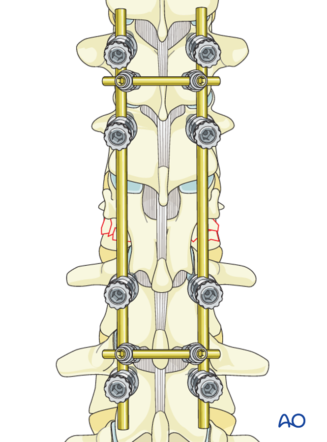 Posterior long segment fixation for A4 Complete burst fractures