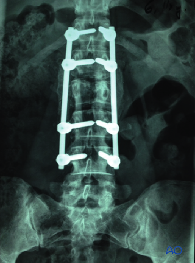 Posterior long segment fixation for B3 Hyperextension