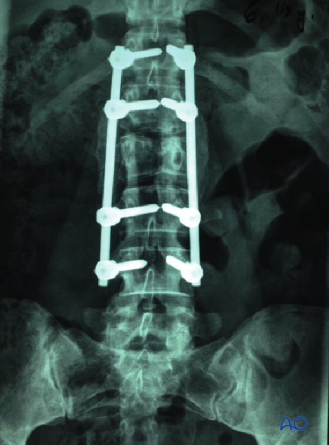 Posterior long segment fixation for B3 Hyperextension