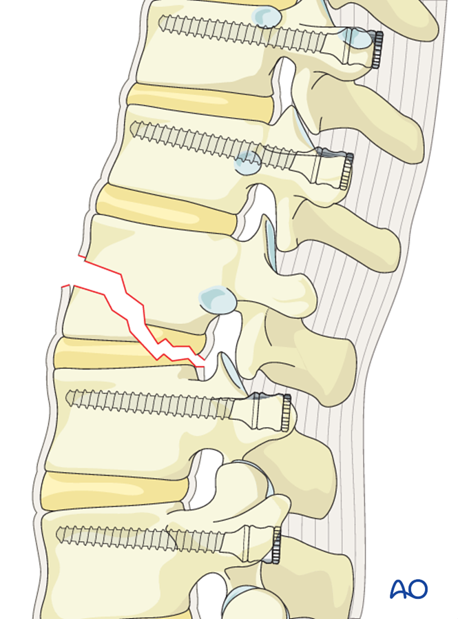 Posterior long segment fixation for B3 Hyperextension