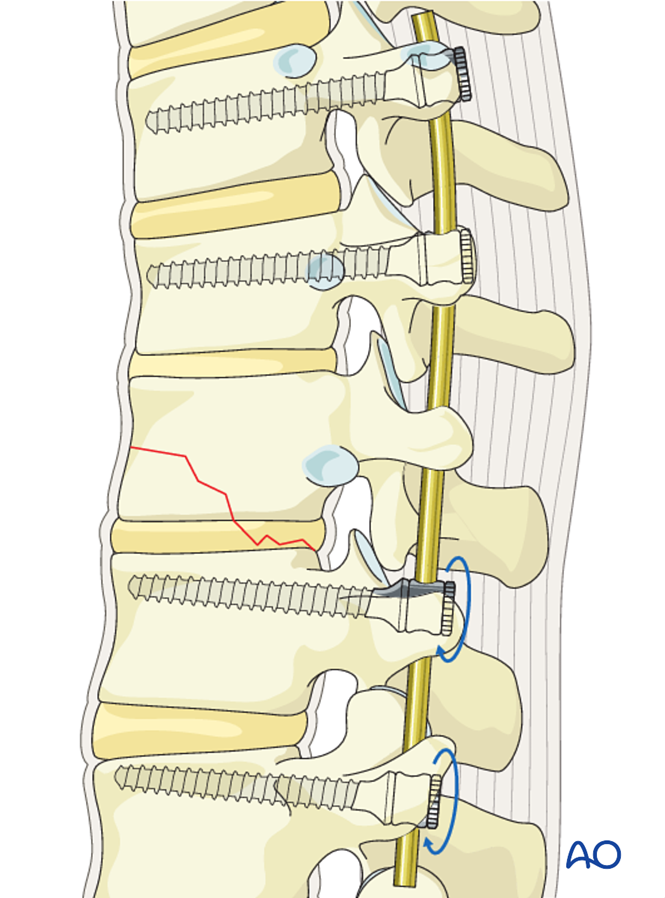 Posterior long segment fixation for B3 Hyperextension