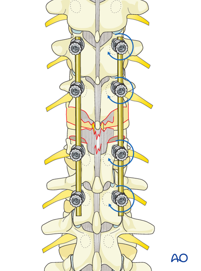Posterior long segment fixation (C) for C Displacement or dislocation