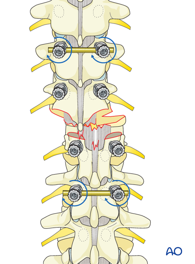 Posterior long segment fixation (C) for C Displacement or dislocation