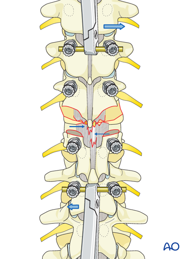 Posterior long segment fixation (C) for C Displacement or dislocation