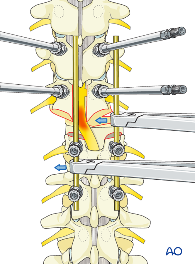 Posterior long segment fixation (C) for C Displacement or dislocation