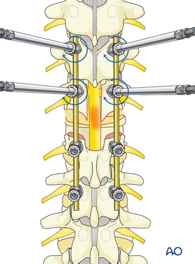 Posterior long segment fixation (C) for C Displacement or dislocation