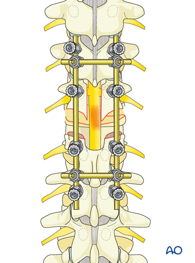 Posterior long segment fixation (C) for C Displacement or dislocation