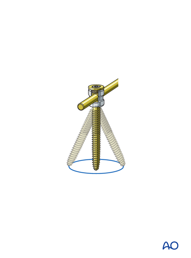 MIS posterior short segment fixation with pedicle screws for B2 ...