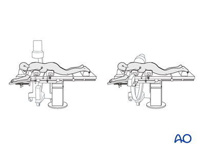 Prone position for posterior open approach - midline approach (T1-S1)