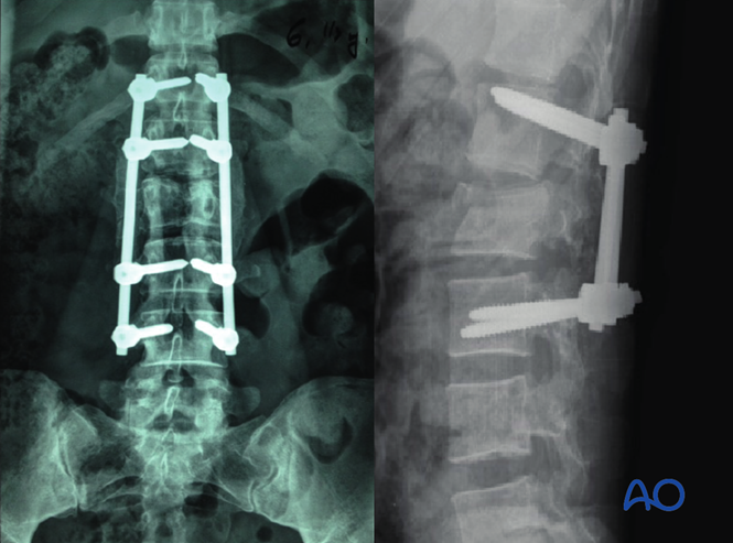 Posterior short segment fixation with Schanz pins for A2 - Split fractures