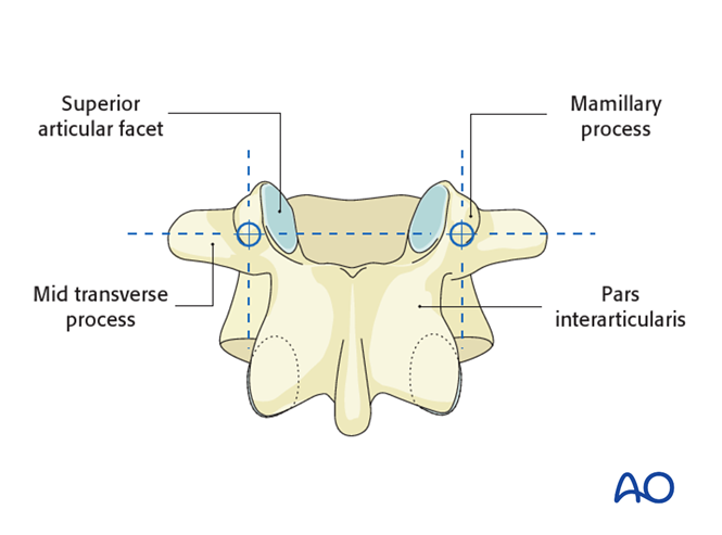 Pedicle screw insertion in the lumbar spine