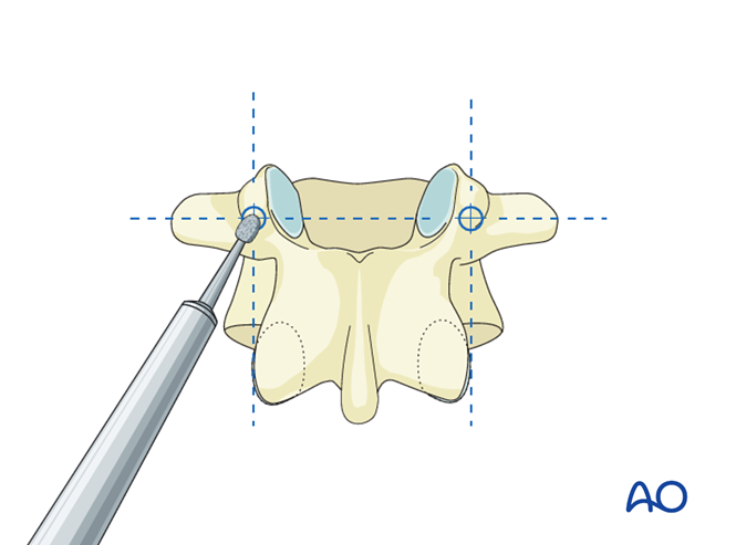 Pedicle screw insertion in the lumbar spine