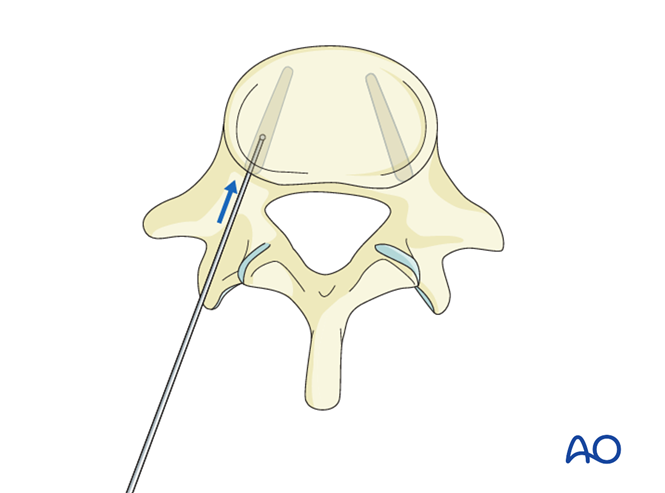 Schanz pin insertion in the thoracolumbar spine