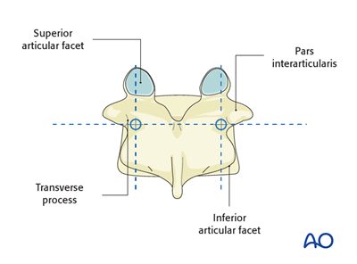 Schanz pin insertion in the thoracolumbar spine