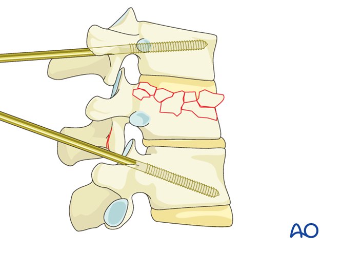 Schanz pin insertion in the thoracolumbar spine