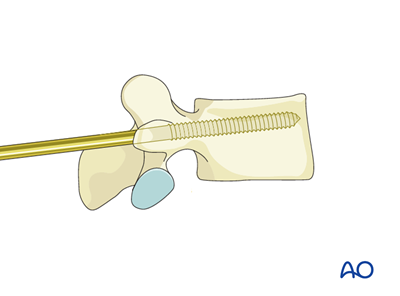 Schanz pin insertion in the thoracolumbar spine