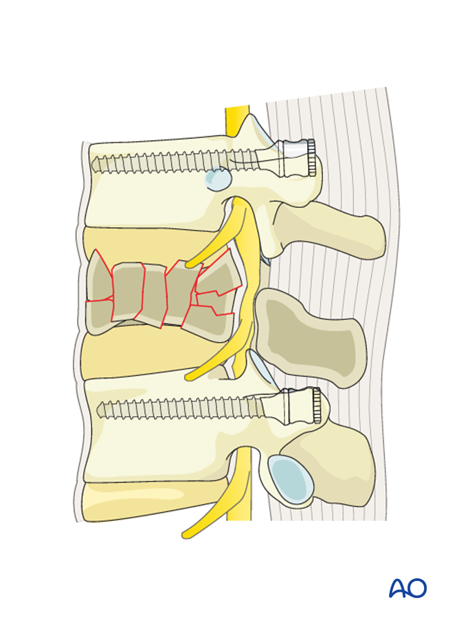 Posterior decompression techniques in the thoracolumbar spine